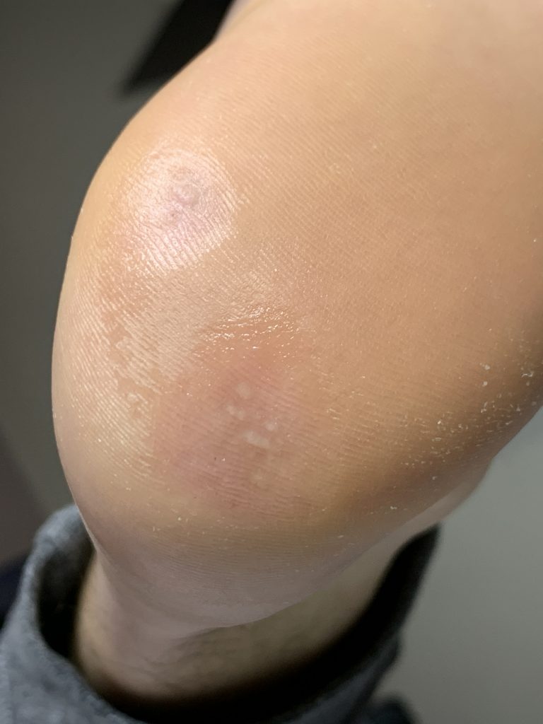 Needling Treatment for Stubborn Verruca Multiple Verruca | A&A ...