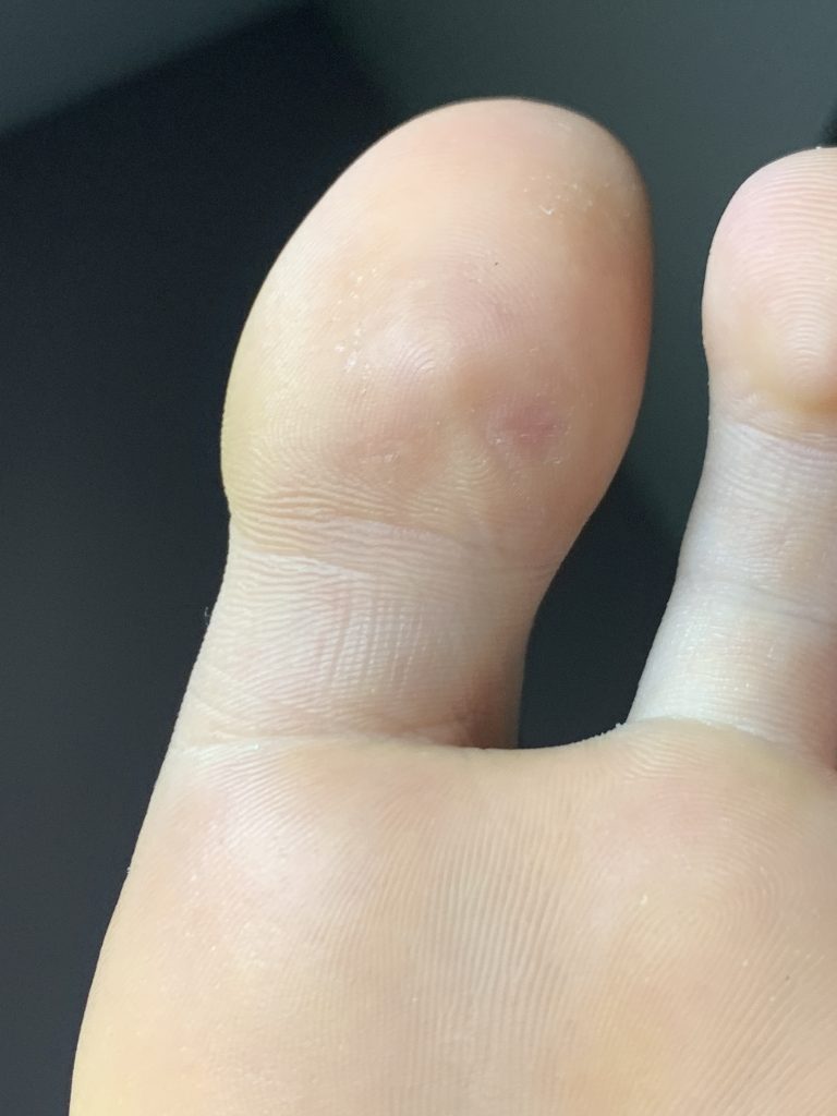 Needling Treatment for Stubborn Verruca Multiple Verruca | A&A ...