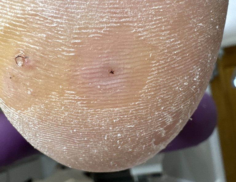 Patient D – after two treatments with Swift Microwave Emblation | A&A ...